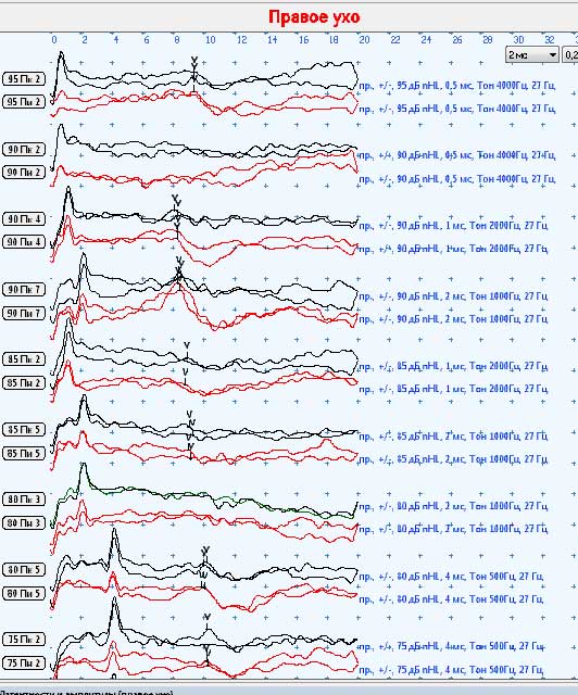 КСВП на тональные посылки - Статья - Медицинский центр МастерСлух